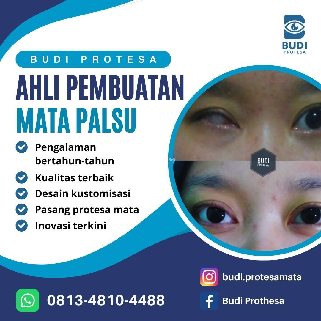 Terpercaya Budi Protesa Pembuat Protesa Mata Palsu Prostetik di ...