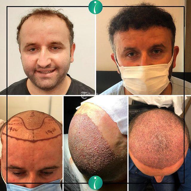 Paket Tanam Rambut Turki Ilyas Arslan Hair Clinic di Jakarta Pusat ...