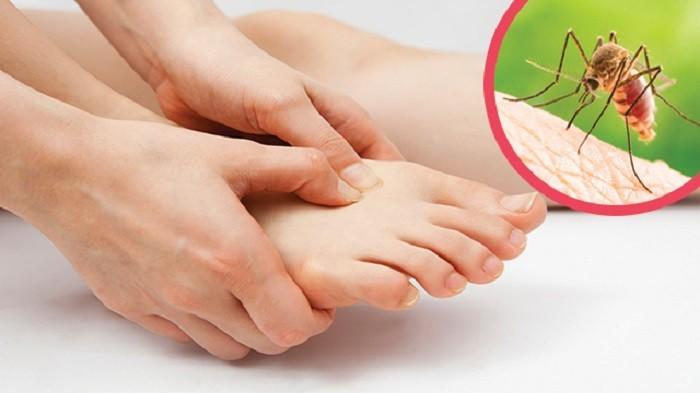 236 Daerah di Indonesia Endemis Penyakit Kaki Gajah, Kenali Gejala dan ...