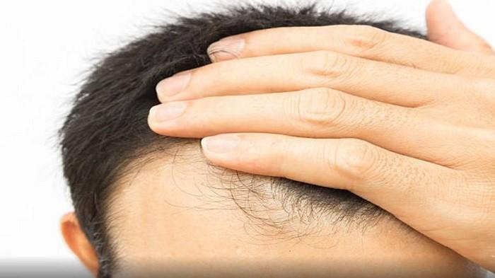 4 Kondisi Rambut yang Patut Anda Ketahui Kaitannya dengan Kesehatan ...