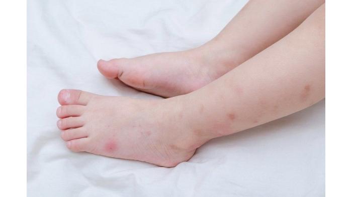 Tak Lagi Muncul Bintik Merah di Kulit, Kenali Gejala Baru DBD yang ...