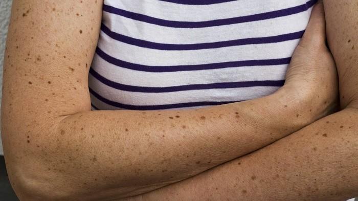 Terlihat Bercak Hitam di Wajah Kamu? Waspadai Tanda-tanda Penyakit Ini ...