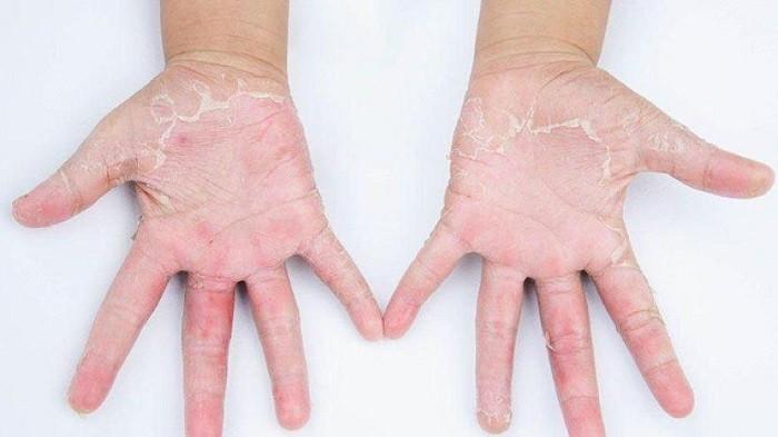 Simak 4 Cara Mengatasi Kulit Tangan Mengelupas dan Kering dengan Mudah ... Simak 4 Cara Mengatasi Kulit Tangan Mengelupas dan Kering dengan Mudah ...